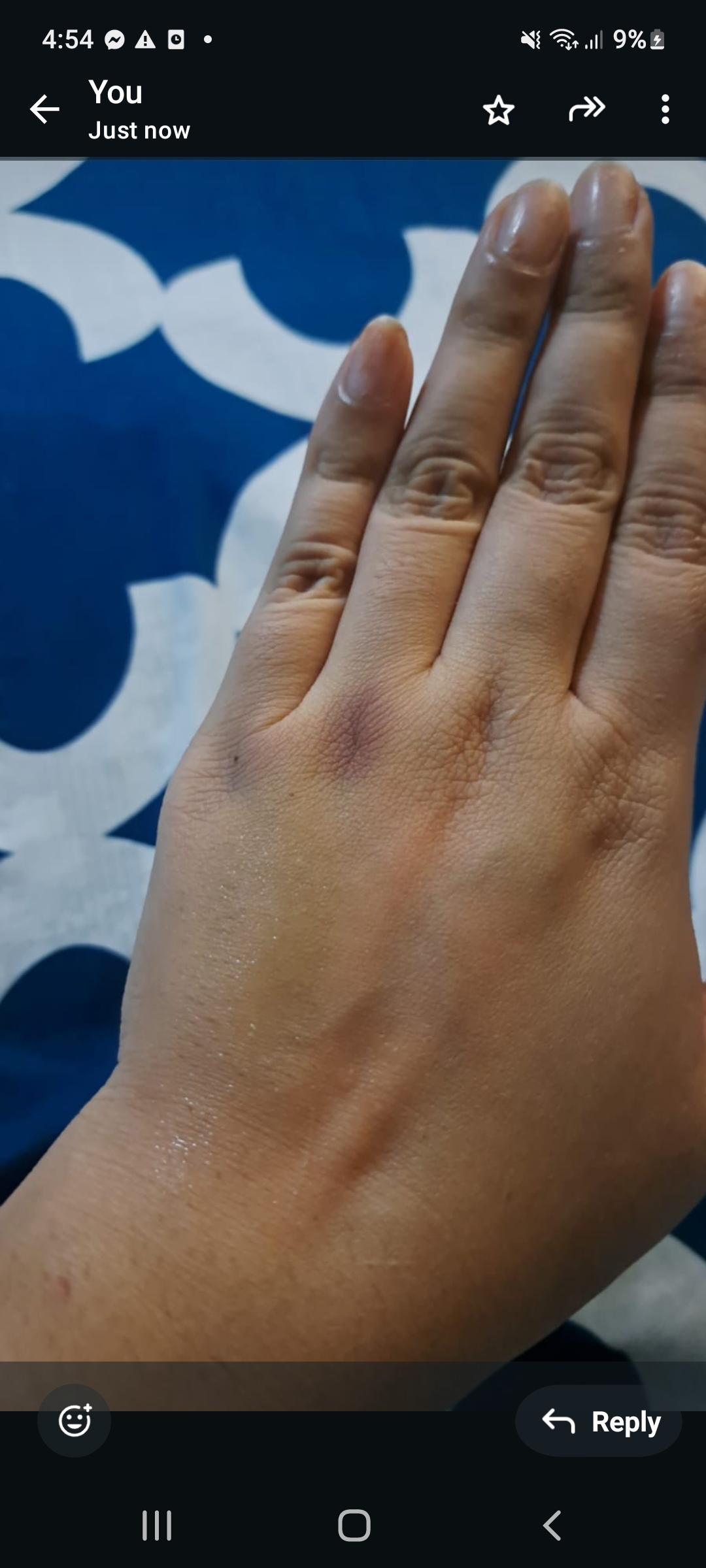 Ask a Dermatologist Online for Skin Brusing