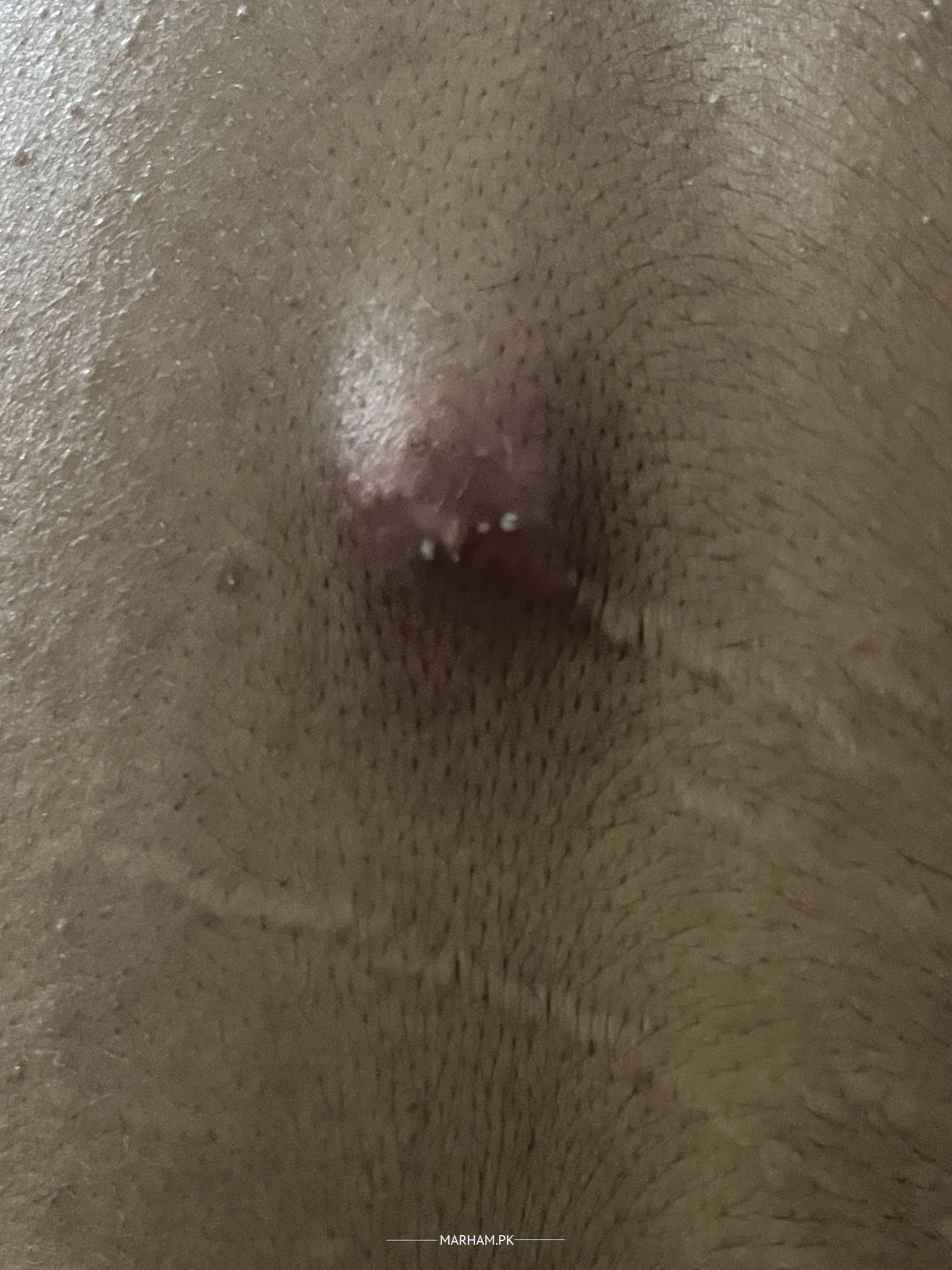 Ask a Gynecologist Online for Sebaceous Or Epidermoid Cyst