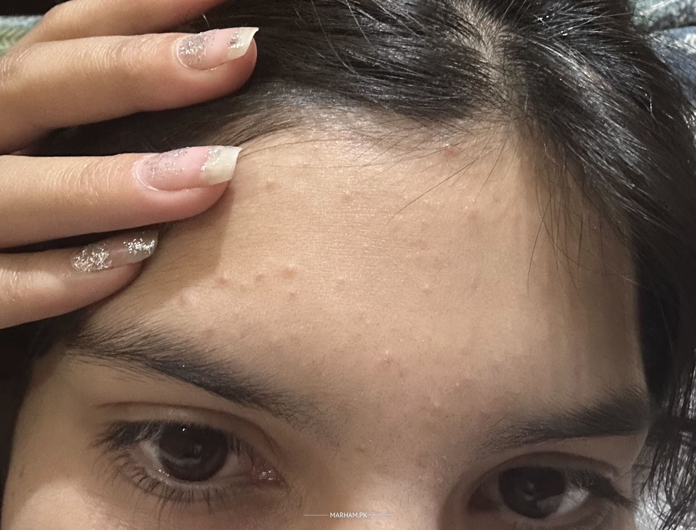 Ask a Dermatologist Online for Skin Acne Pimples