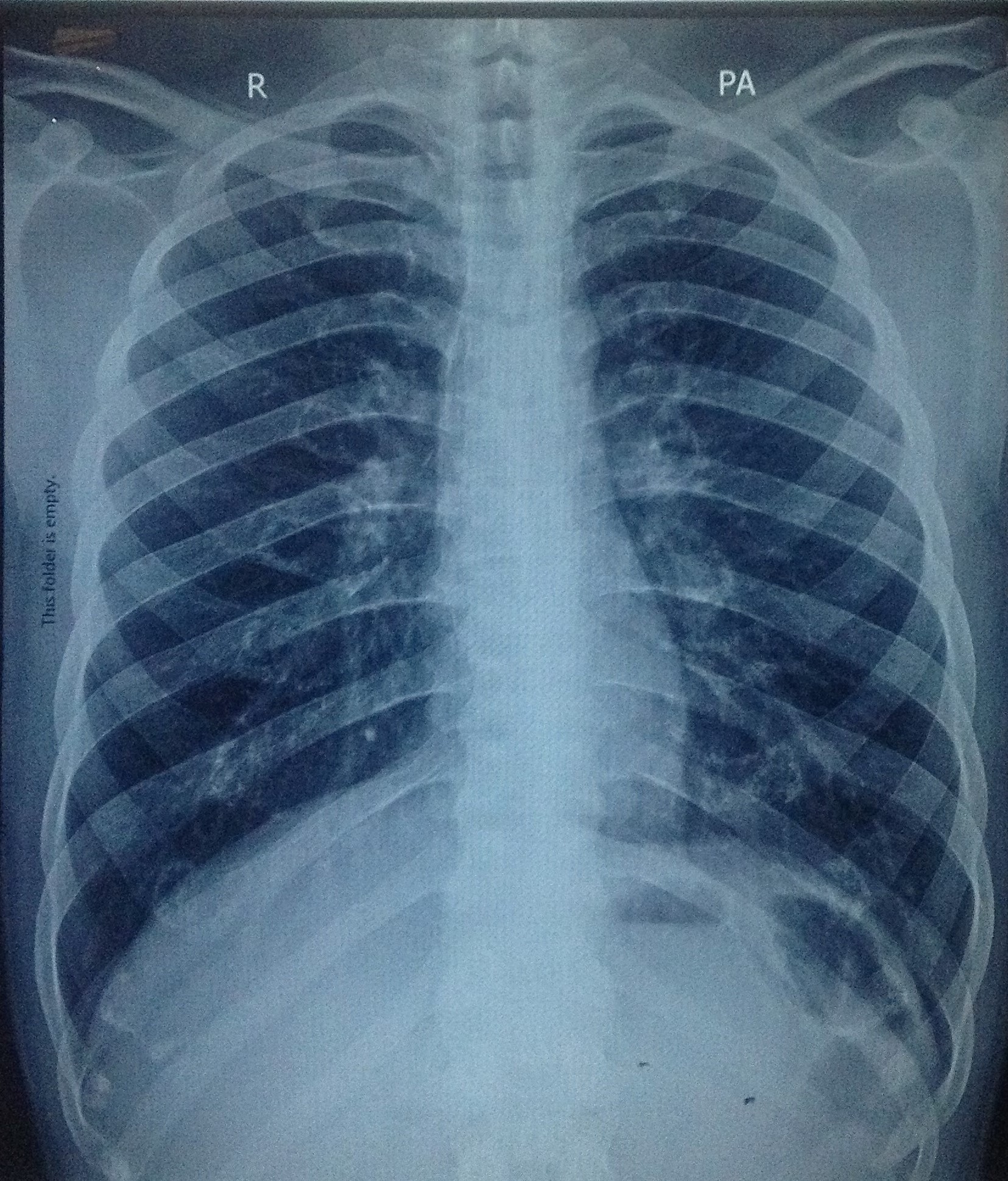 Ask a Pulmonologist / Lung Online for X Ray Findings