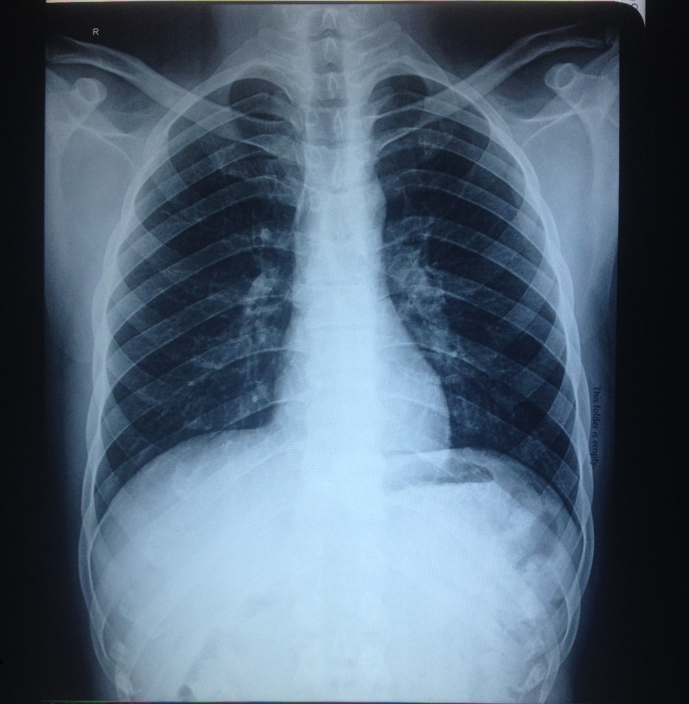 Ask a Pulmonologist / Lung Online for X Ray Findings