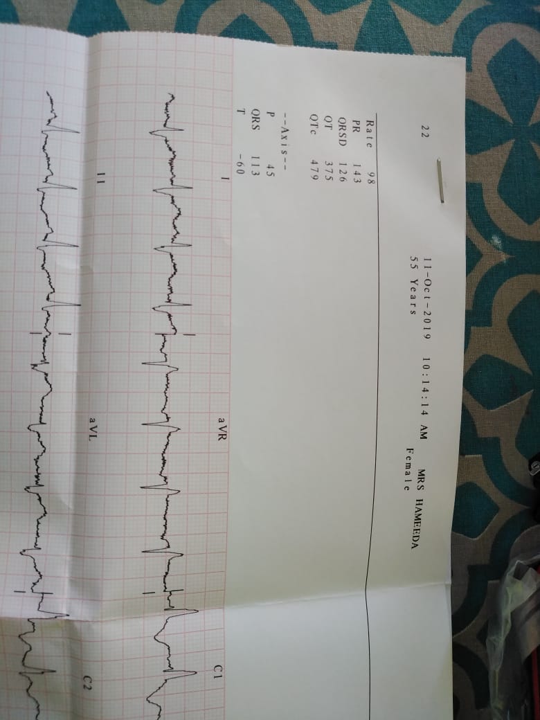 Ask a Cardiologist Online for ECG Findings RBBB