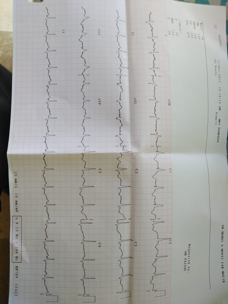 Ask a Cardiologist Online for ECG Findings RBBB