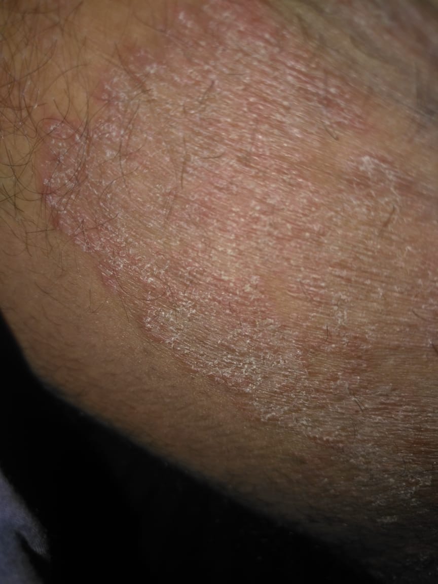 Ask a Dermatologist Online for Fungal Circles Around Private Part