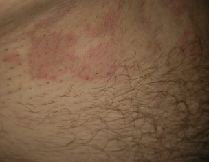 Ask a Dermatologist Online for Fungal Circles Around Private Part