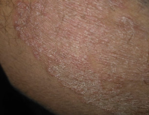 Ask a Dermatologist Online for Fungal Circles Around Private Part