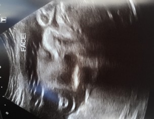 Ask a Gynecologist Online for 26 Week Anatomy Scan