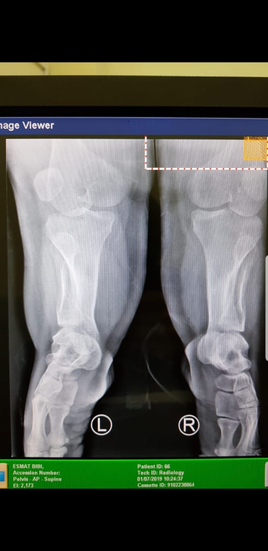Ask a Orthopedic Surgeon Online for Bone Deformities
