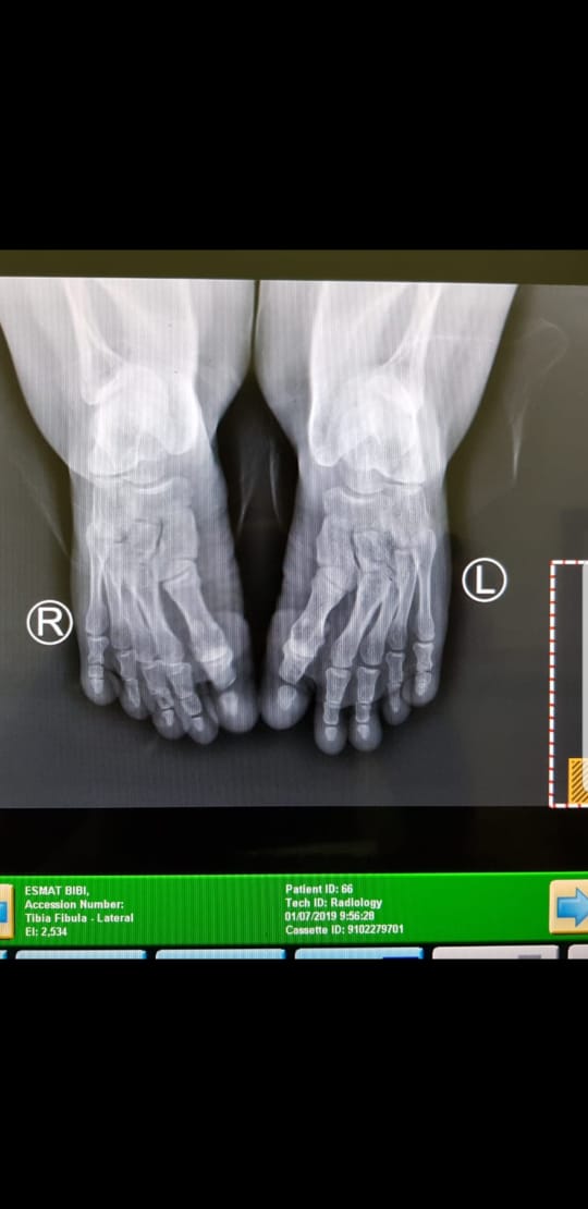 Ask a Orthopedic Surgeon Online for Bone Deformities