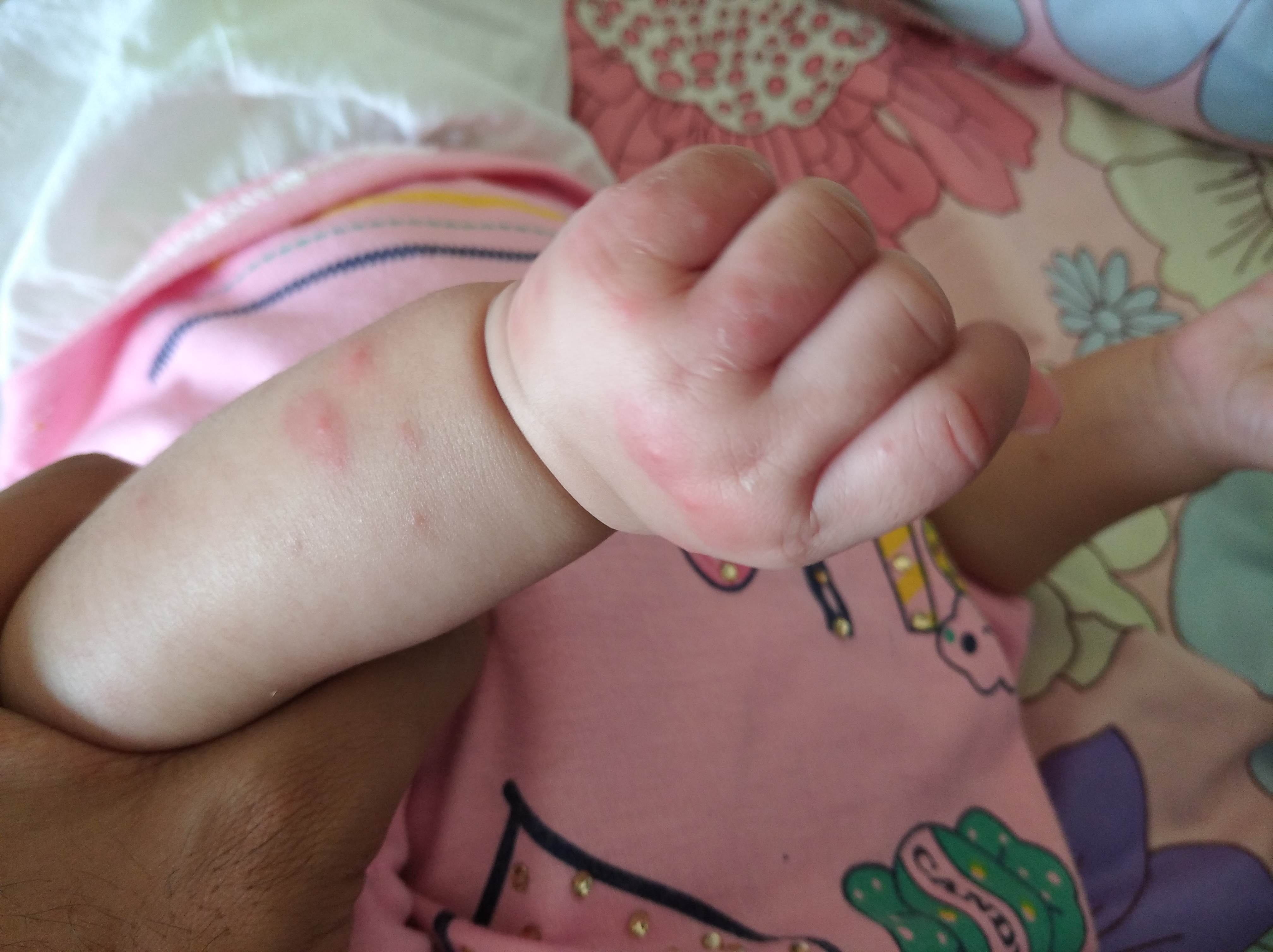 Ask a Dermatologist Online for Rashes (reddish Pimples Type Dots)