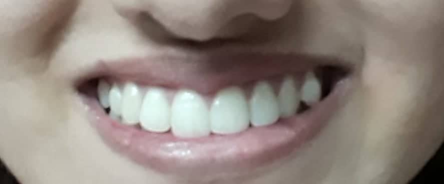 Ask a Dentist Online for Smile Problem