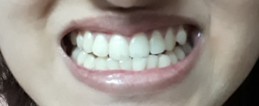 Ask a Dentist Online for Smile Problem