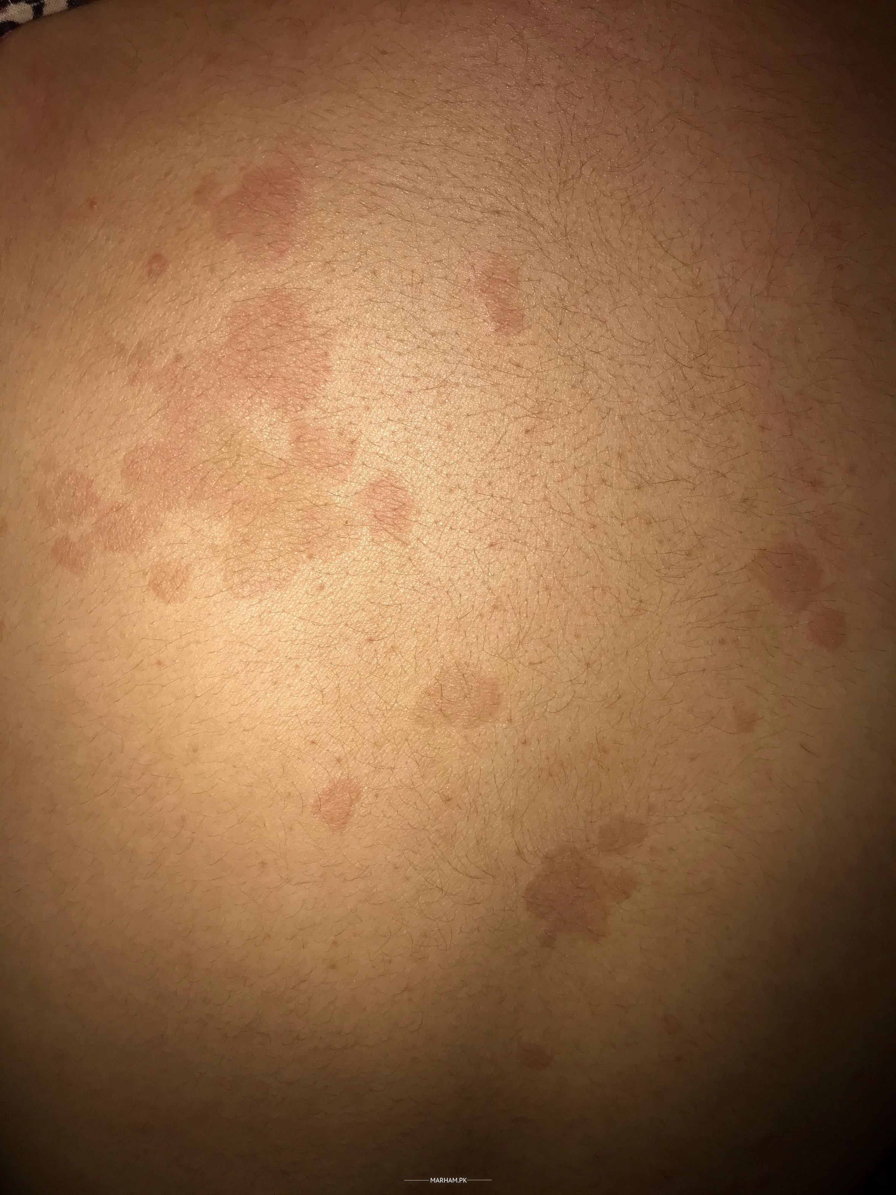 Ask a Dermatologist Online for Brown Patches On Back