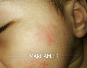 Ask a Pediatrician Online for Red Marks On Face
