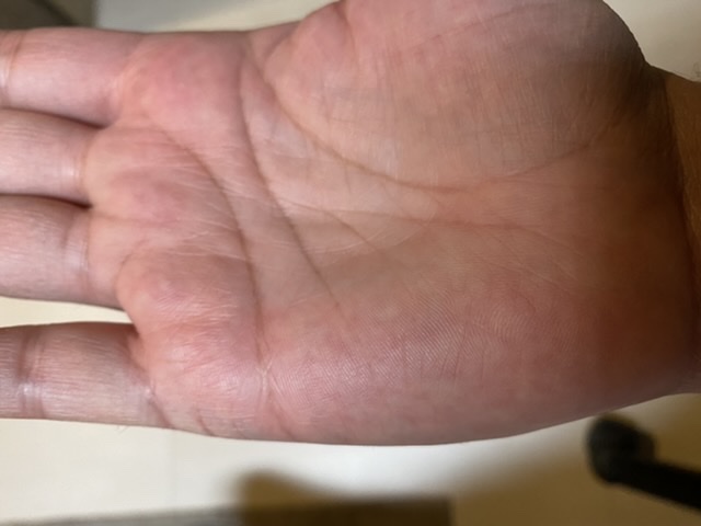 Ask a Dermatologist Online for Pink Spots On Hands