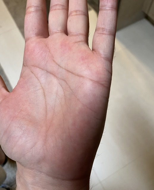 Ask a Dermatologist Online for Pink Spots On Hands