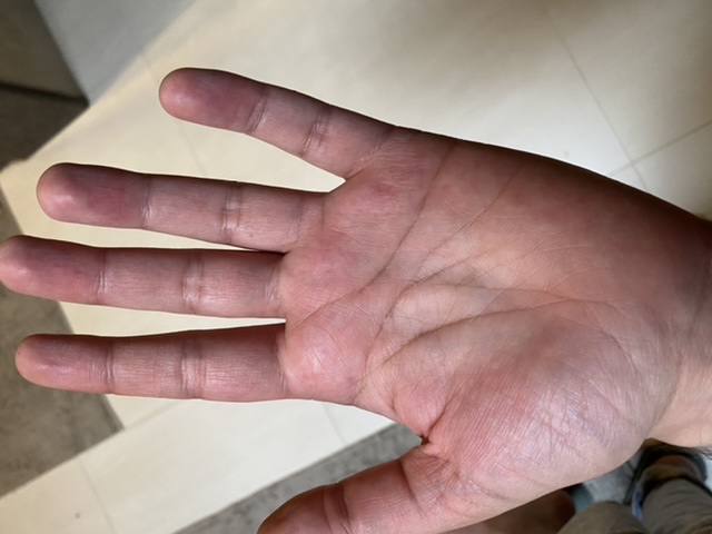 Ask a Dermatologist Online for Pink Spots On Hands