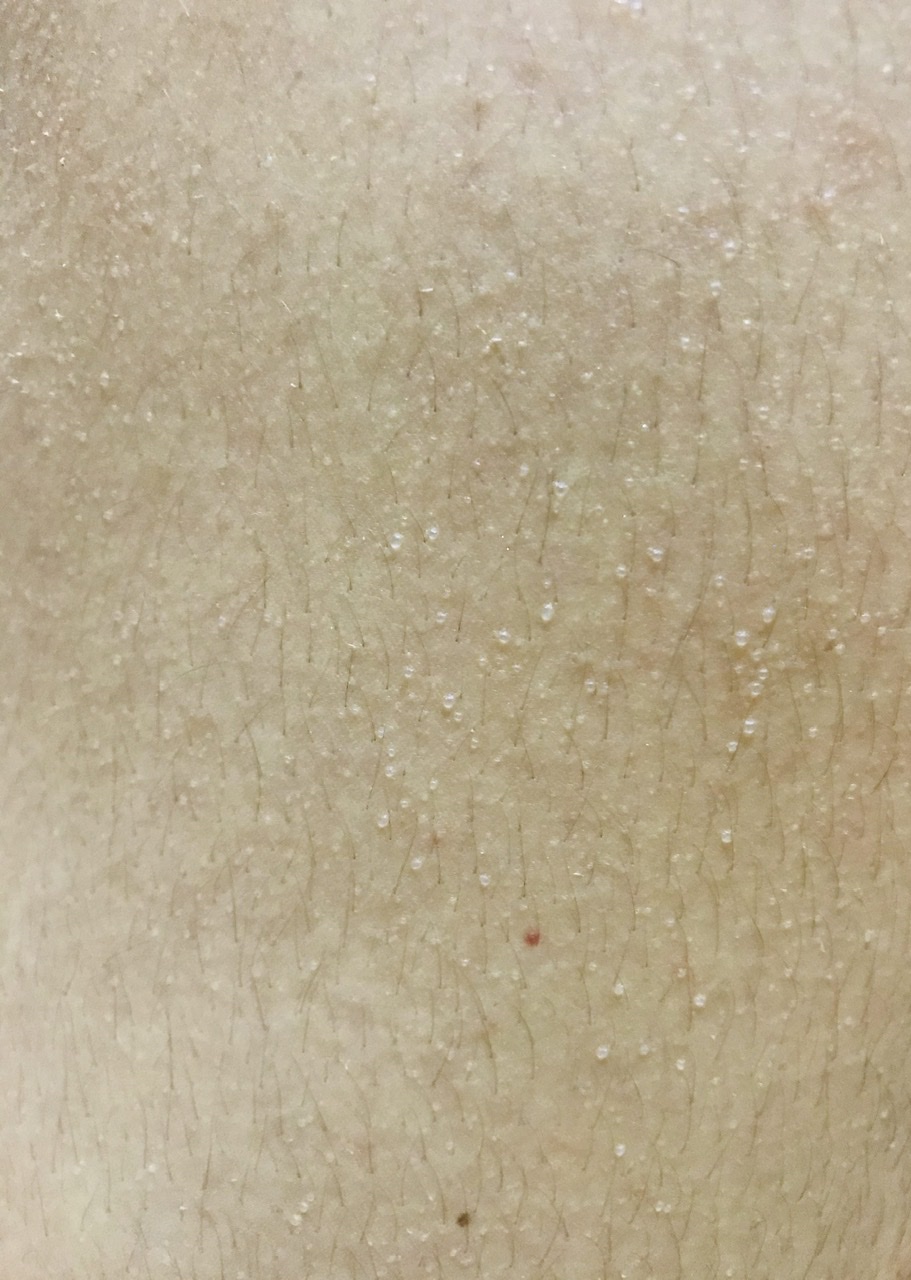Ask a Dermatologist Online for Skin Vesicular Rash