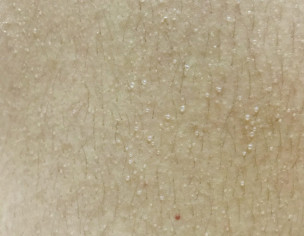 Ask a Dermatologist Online for Skin Vesicular Rash