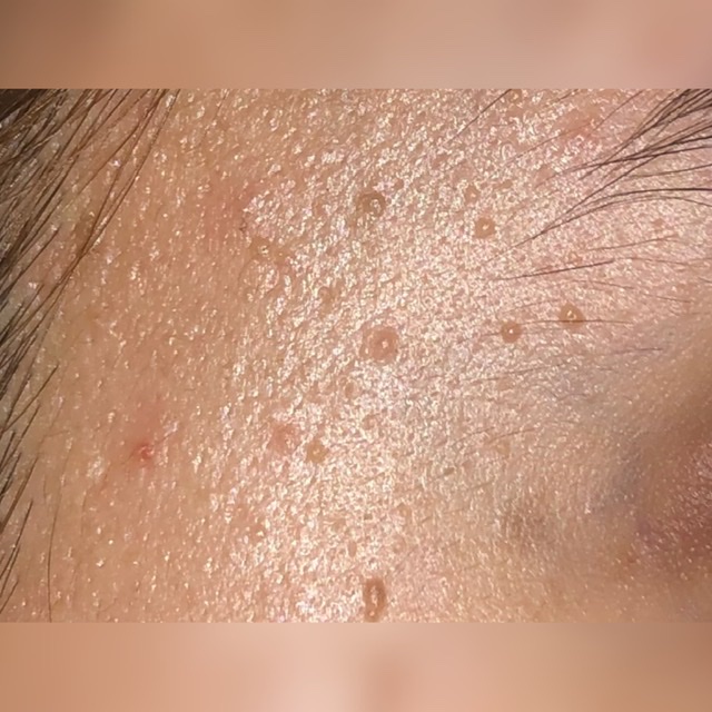Ask a Dermatologist Online for Skin Bumps On Face