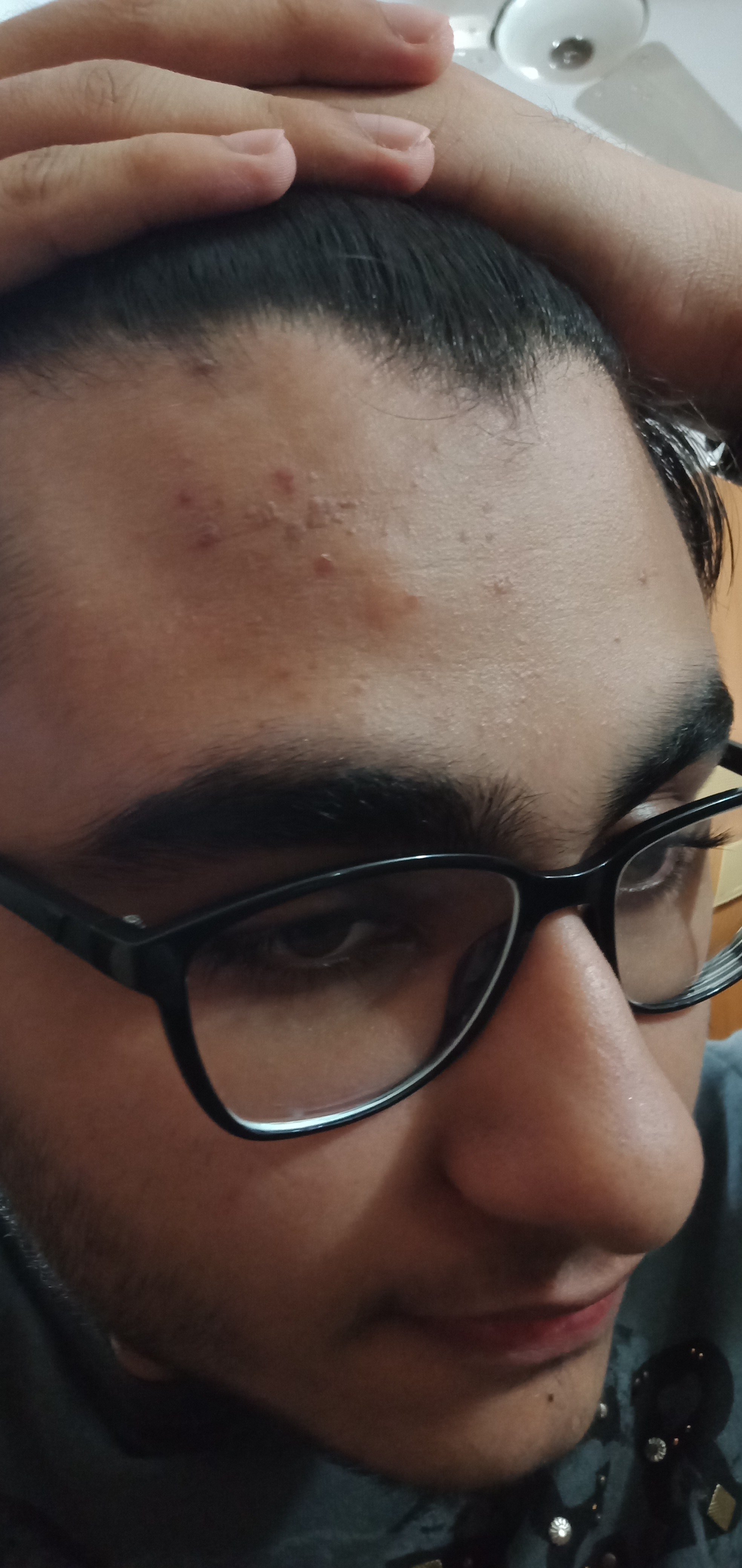 Ask a Dermatologist Online for Skin Tags On Forehead