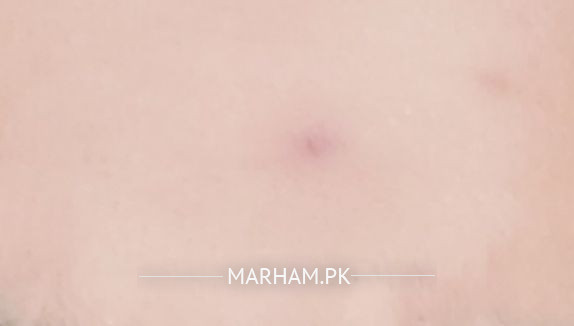 Ask a Dermatologist Online for Cyst Scars