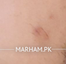 Ask a Dermatologist Online for Cyst Scars