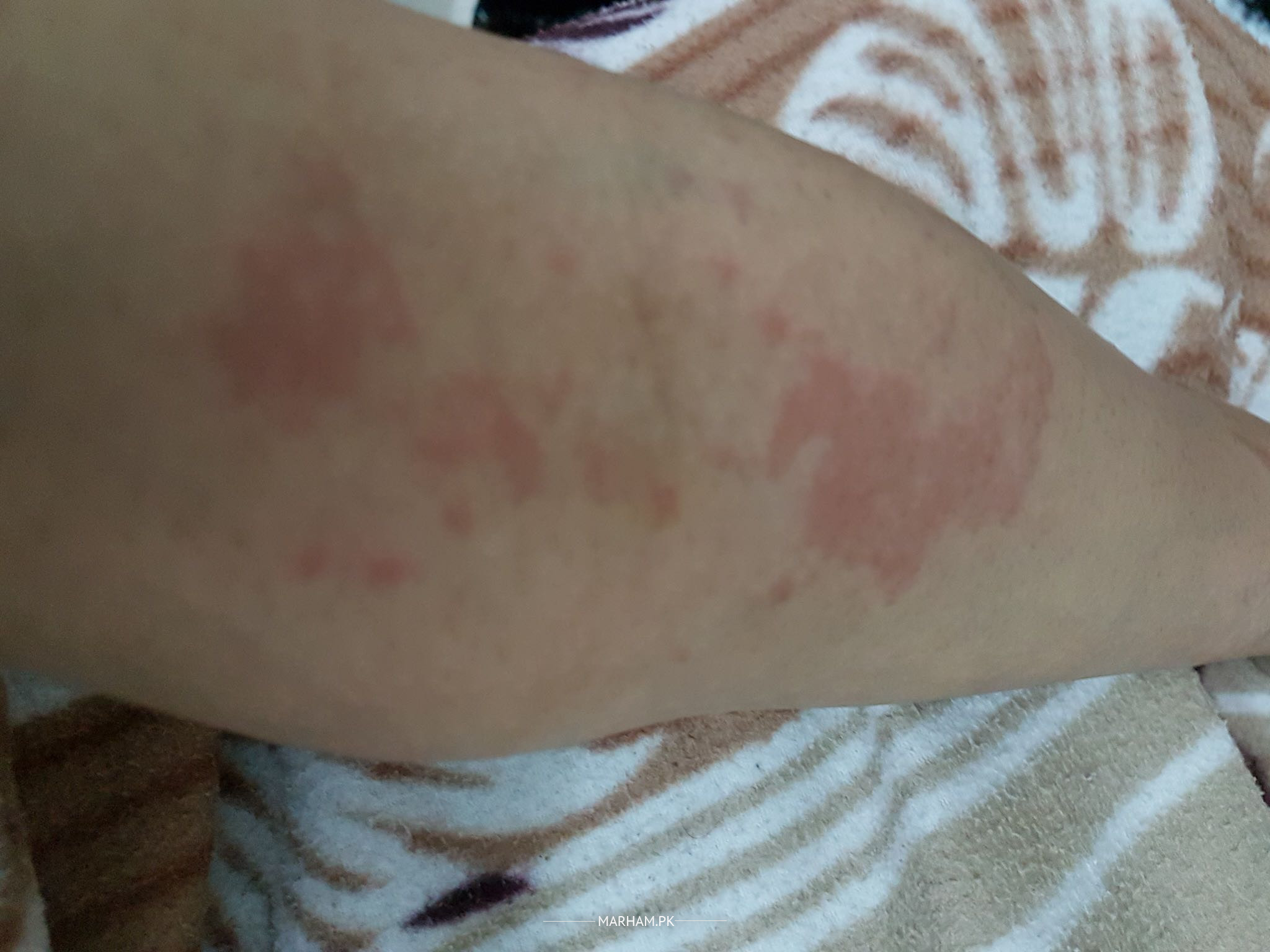 Ask a Dermatologist Online for Acute Urticaria