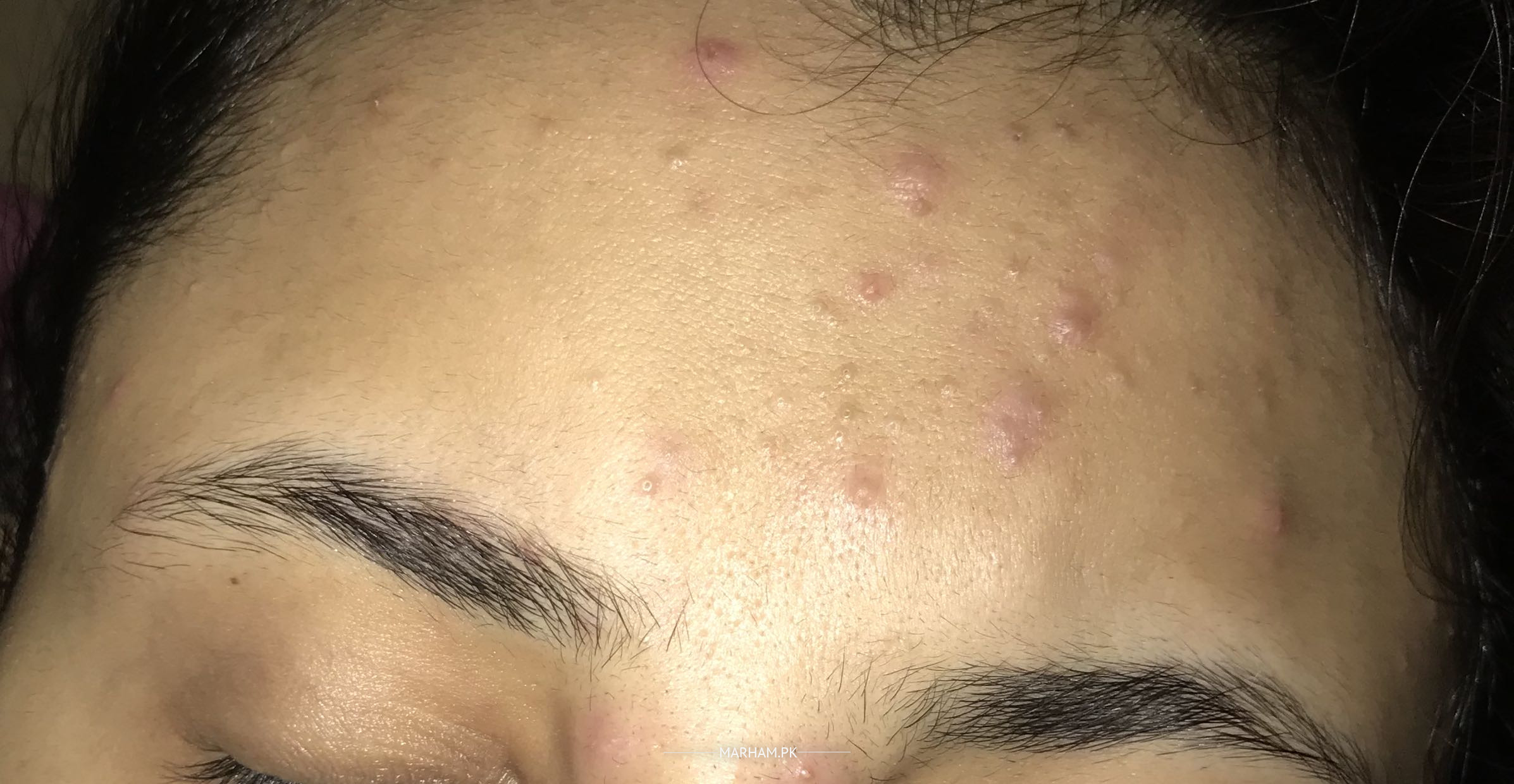 Ask a Dermatologist Online for Severe Acne Of All Face