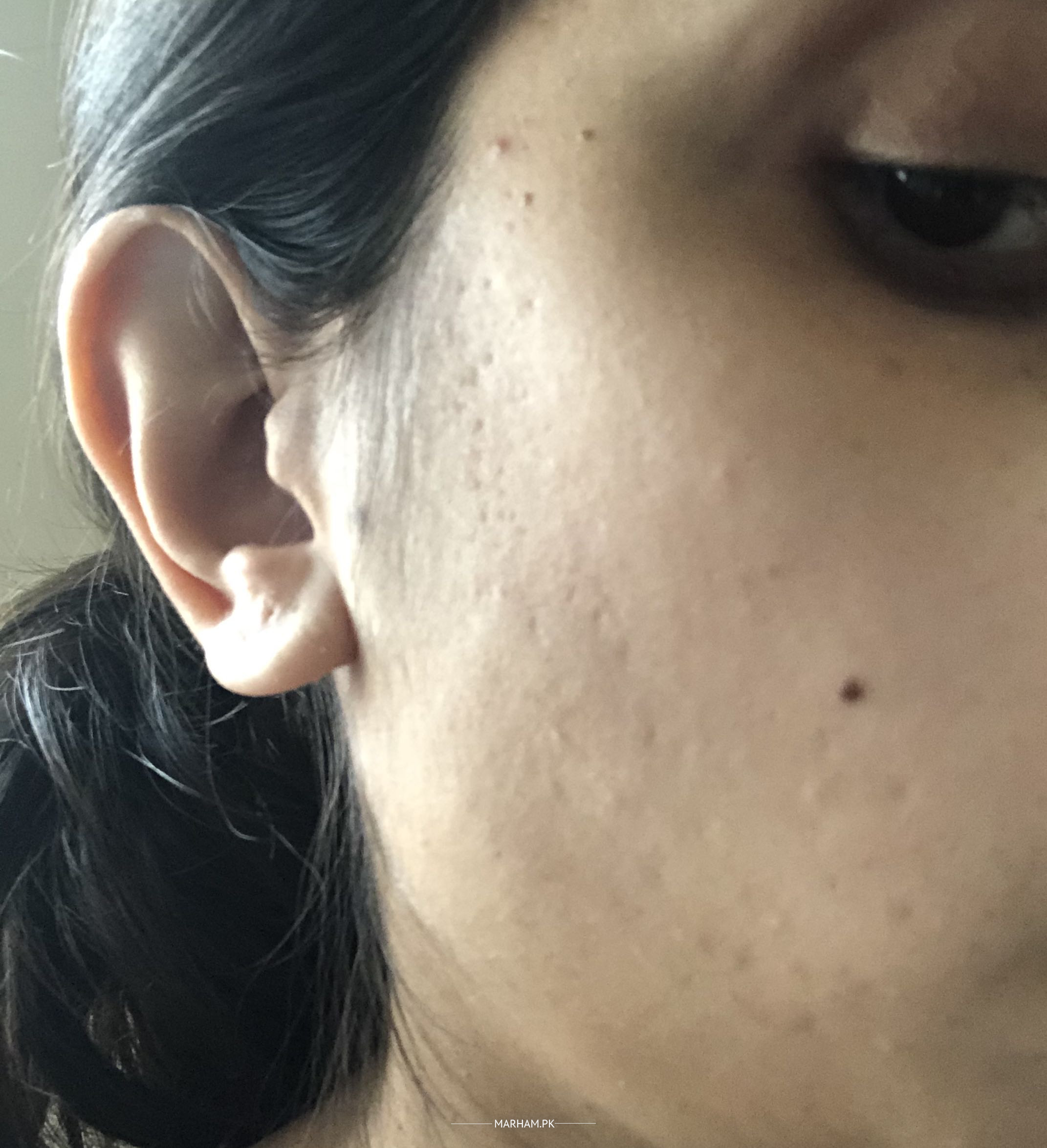 Ask a Dermatologist Online for Pitted Skin