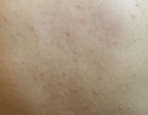 Ask a Dermatologist Online for Back Acne