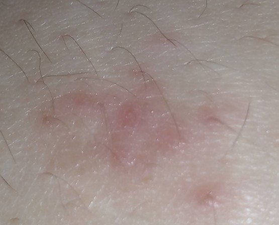 Ask a Gastroenterologist Online for Belly Button