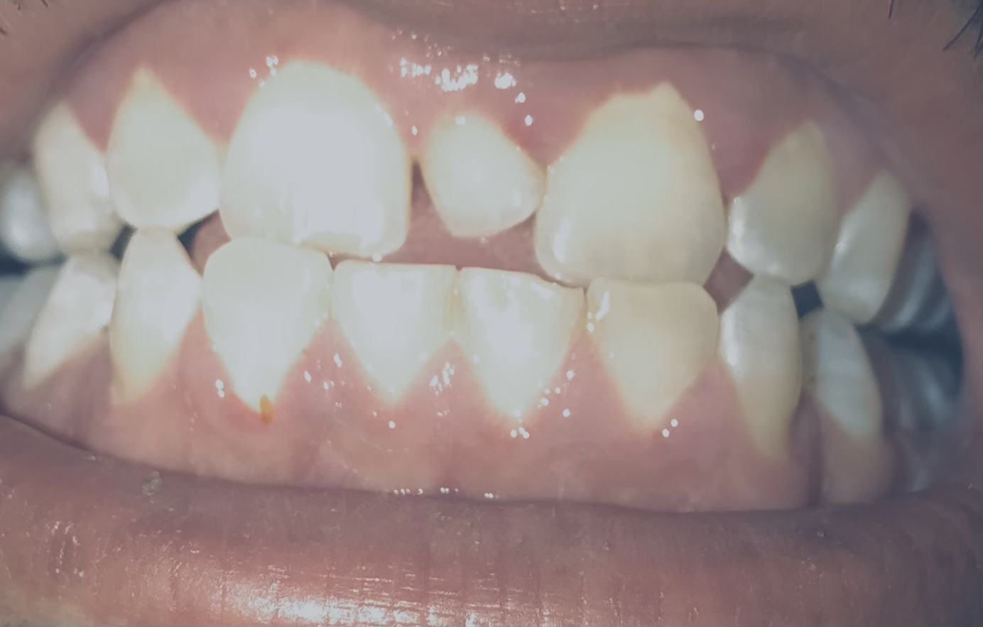 Ask a Dentist Online for Middle Upper Tooth Size And Dimensions Prob