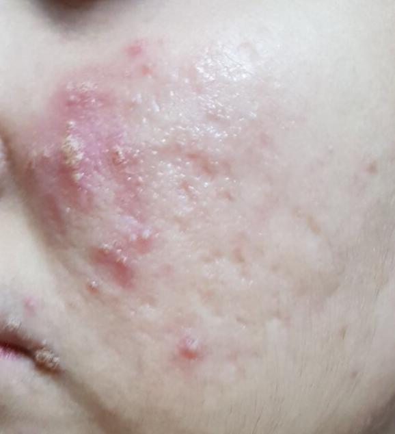 Ask a Dermatologist Online for ACTIVE ACNE WITH SCARS