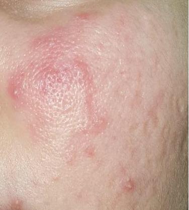 Ask a Dermatologist Online for ACTIVE ACNE WITH SCARS