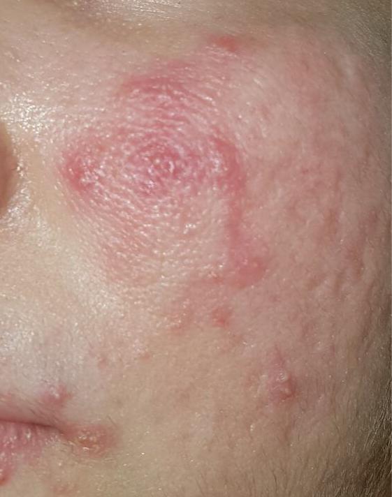 Ask a Dermatologist Online for ACTIVE ACNE WITH SCARS