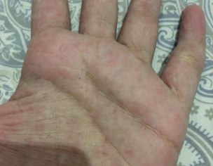 Ask a Dermatologist Online for Red Spots On Hand