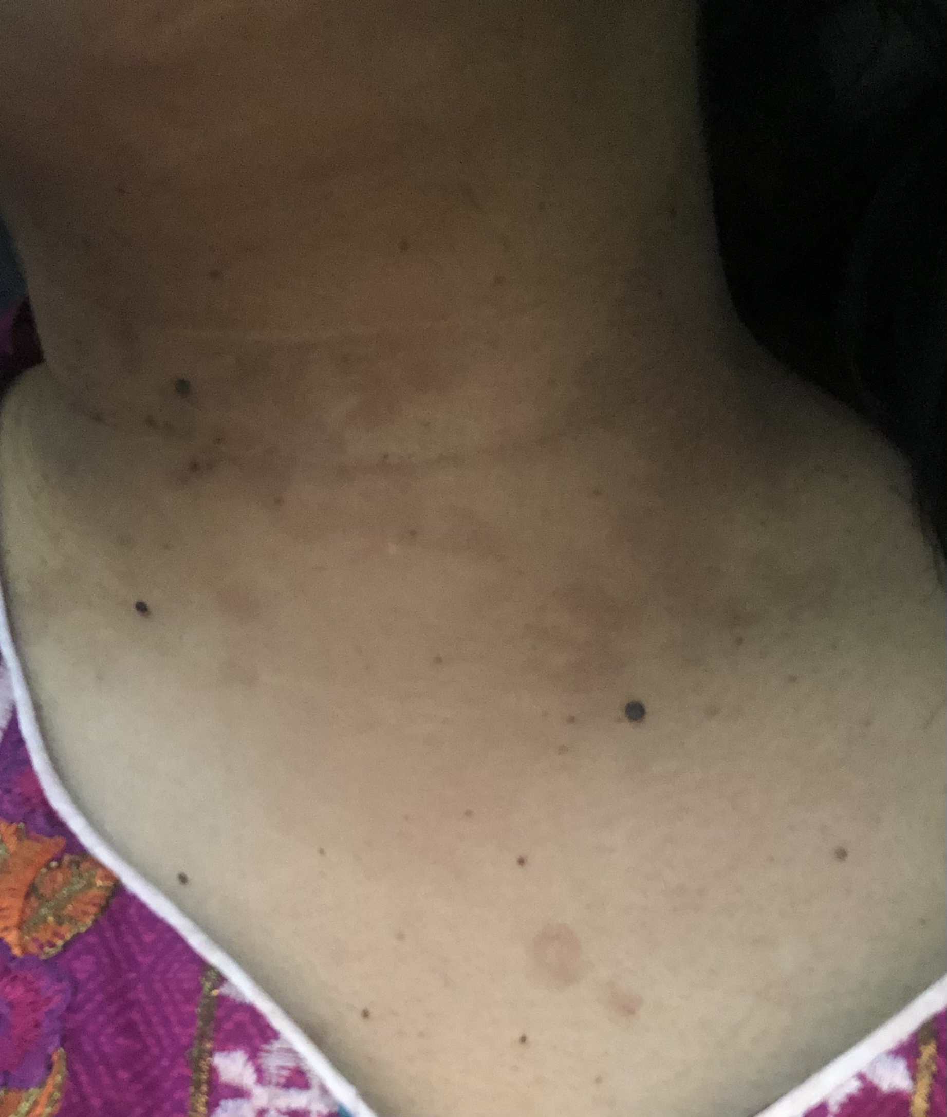 Ask a Dermatologist Online for Skin Pigmentation/moles On Neck