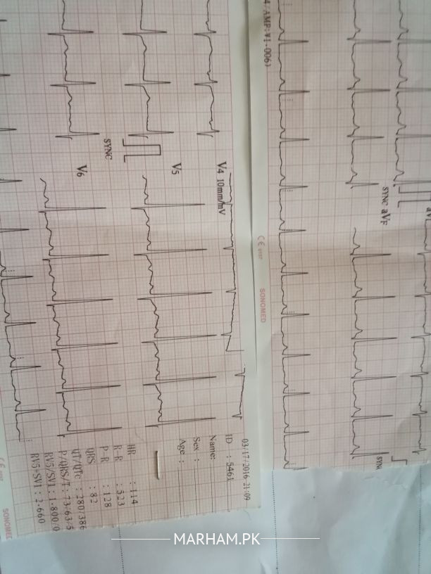 Ask a General Physician Online for ECG Check