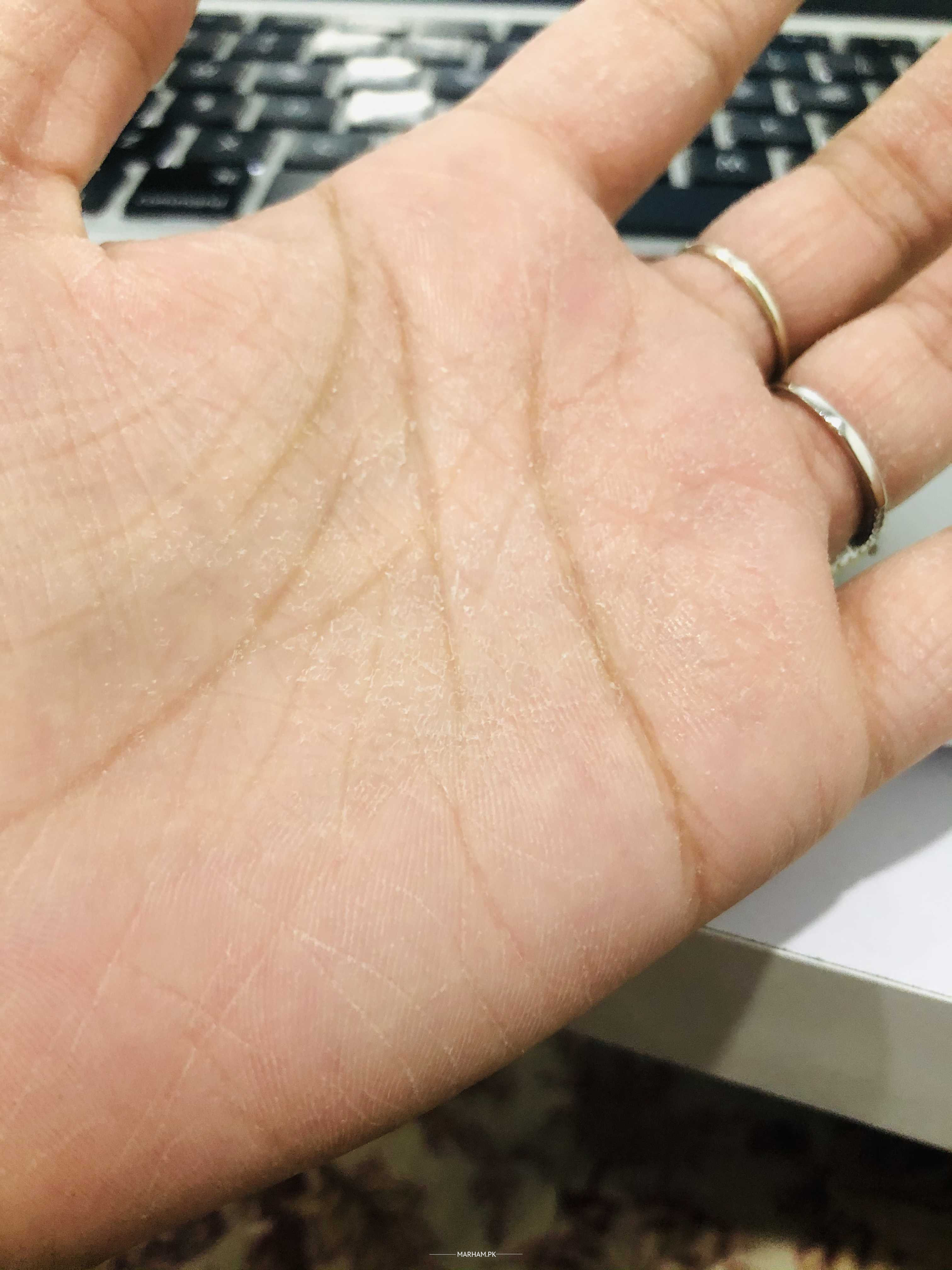 Ask a Dermatologist Online for Dry/scaly Skin