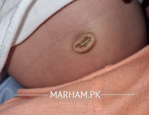 Ask a Pediatrician Online for Infant Belly Button