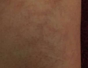Ask a Dermatologist Online for Have Red Lines On My Legs