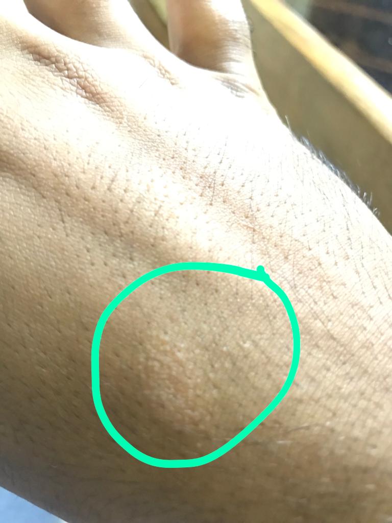 Ask a Dermatologist Online for Skin Rashes On Hand Causing Irritation