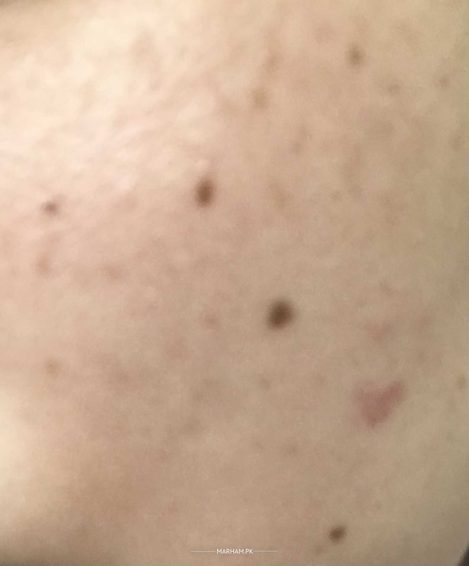 Ask a Dermatologist Online for Brown Spots( Dots) On Face