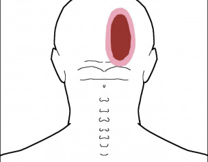 Ask a Radiologist Online for Headache Half Back Side Of Head