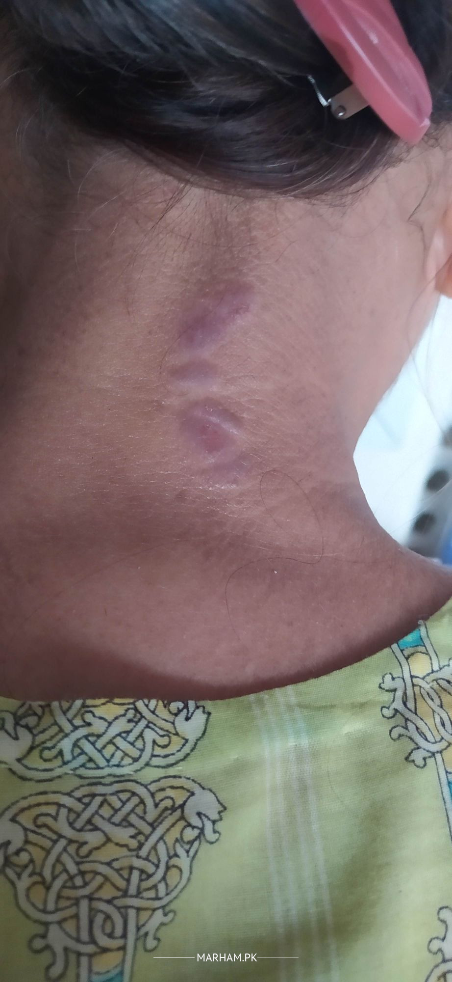 Ask a Dermatologist Online for Skin Problem On Neck