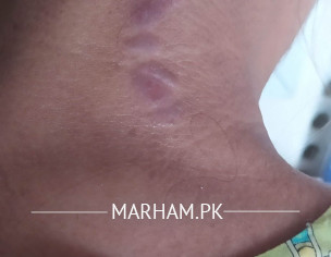 Ask a Dermatologist Online for Skin Problem On Neck