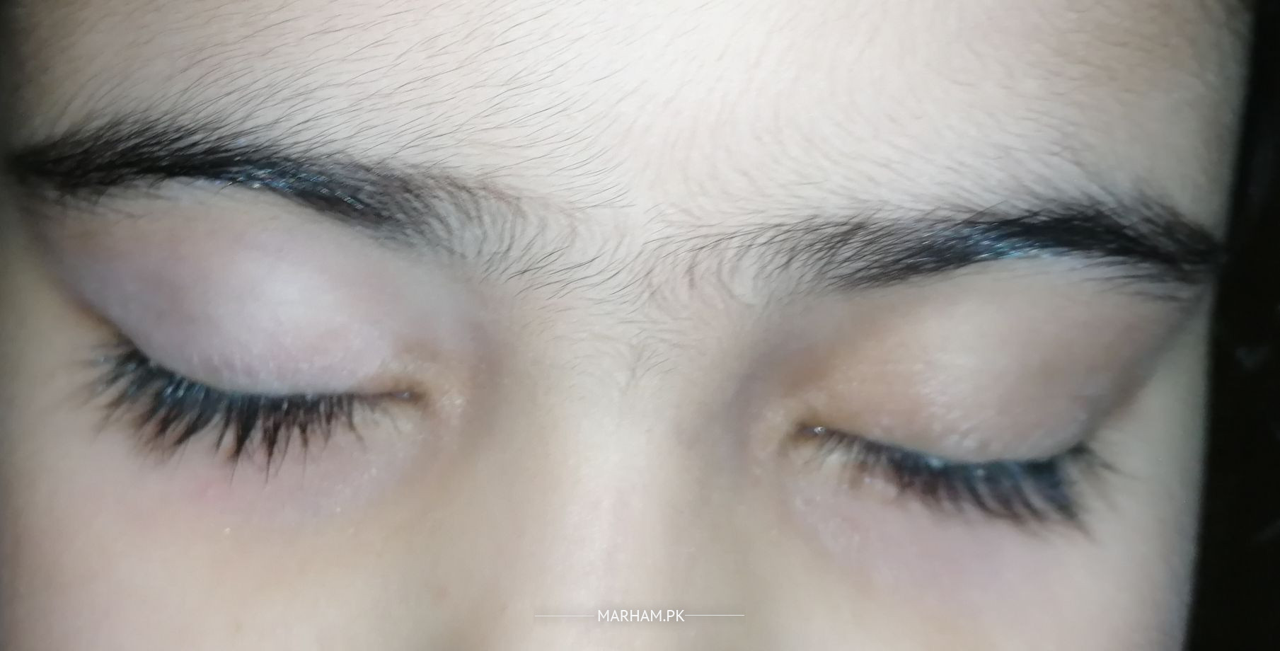 Ask a Dermatologist Online for White Patch On Left Eye Lid