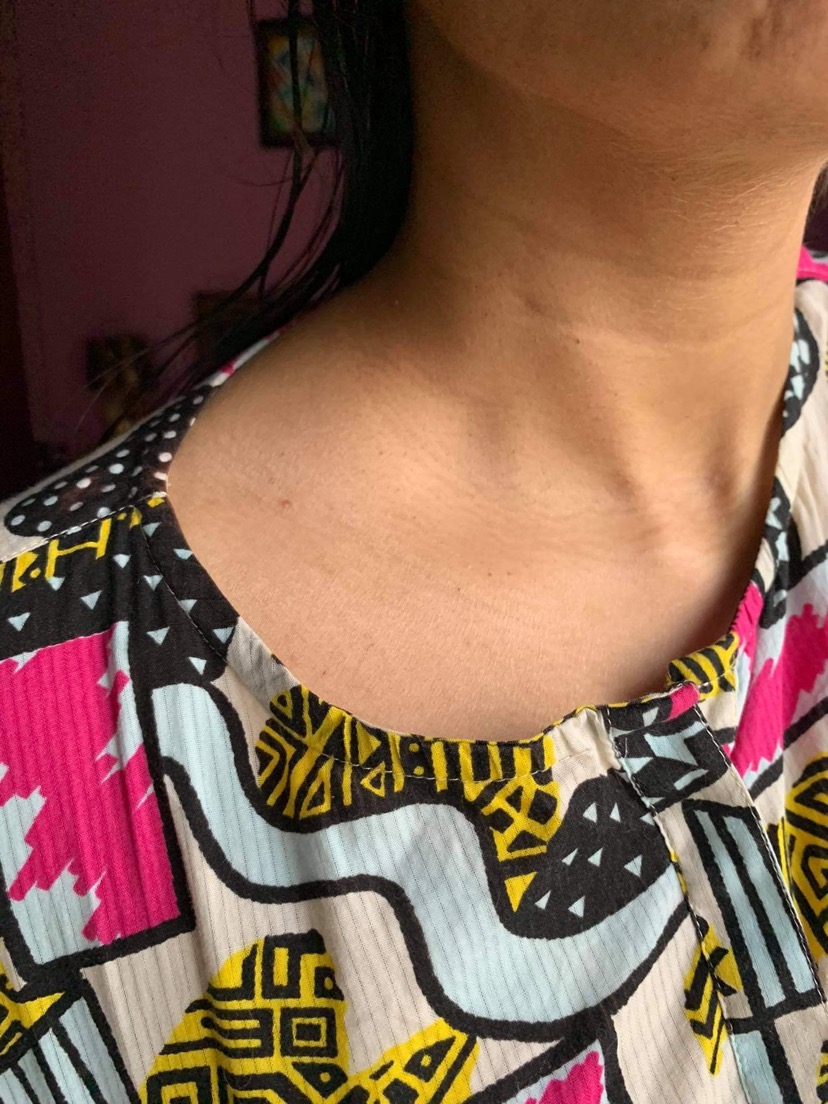 Ask a Dermatologist Online for Texture / Dark Lines On Neck