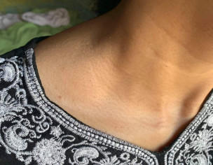 Ask a Dermatologist Online for Texture / Dark Lines On Neck